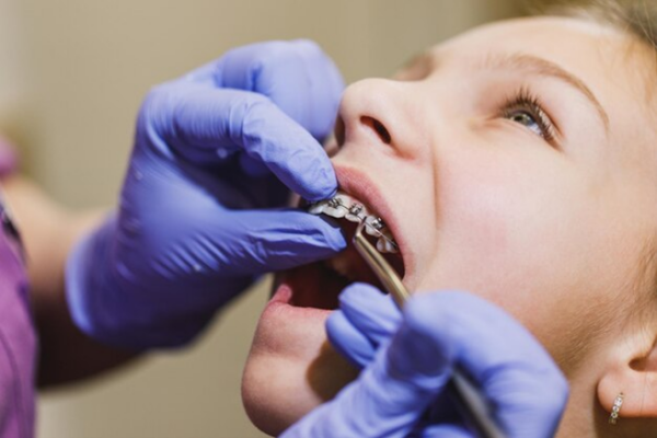 The Complete Guide to Metal Dental Braces: What You Need to Know ...